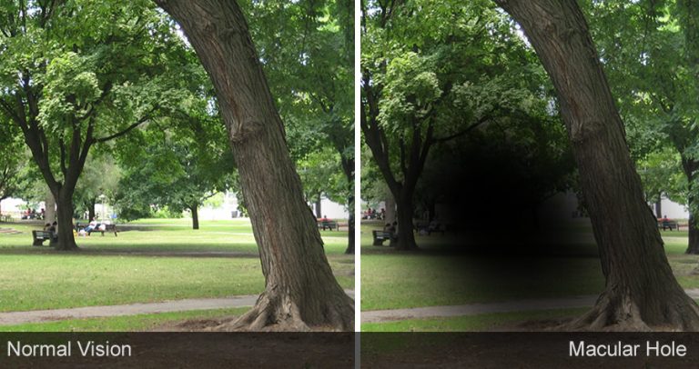 Comprehensive Guide to Macular Hole Treatment: From Diagnosis to ...