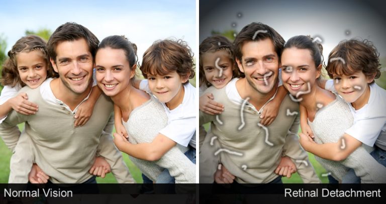 Retinal Detachment - Billings Retina and Macula